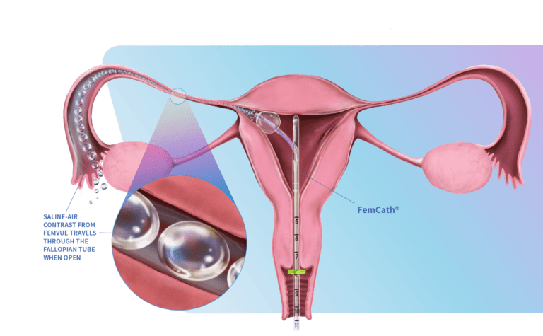 Infertility | Femasys Infertility | Femasys